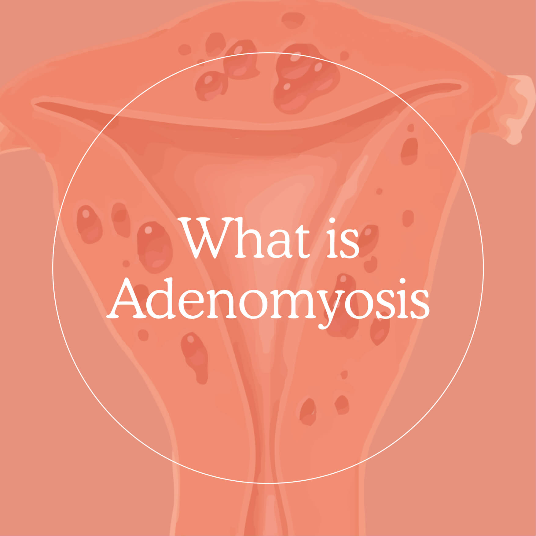 Adenomyosis Severe Symptoms